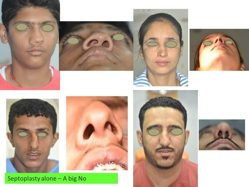 The single most common cause of a Failed Rhinoplasty | by Dr. Brajendra ...