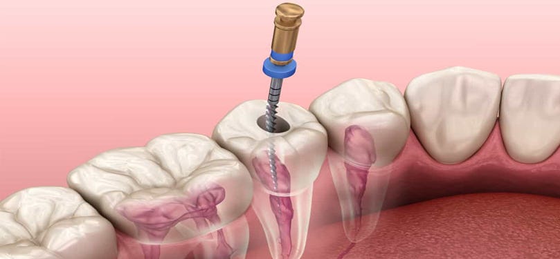 Decoding Dental Care: Insights into Root Canal, Filling, and Whitening ...