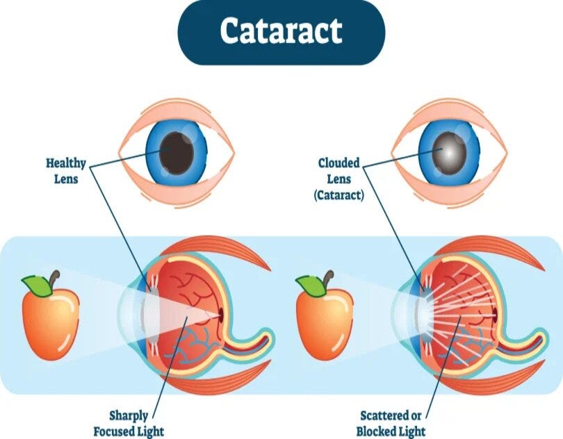 Dr. Seema Behl: Your Trusted Cataract Specialist in Andheri | by Smart ...