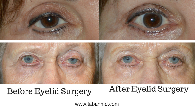 Important Benefits of Eyelid Cosmetic Surgery | by Taban MD | Medium