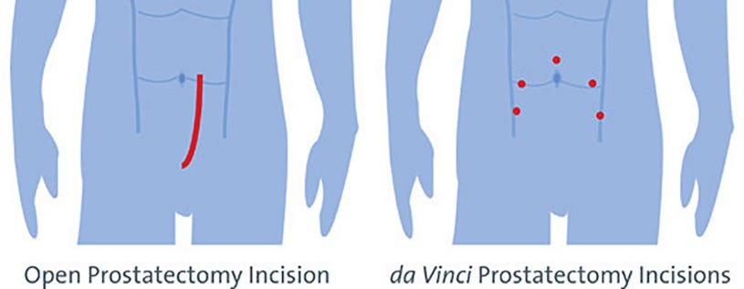 What are the Different Types of Prostate Surgery? | by Nat Stringer ...