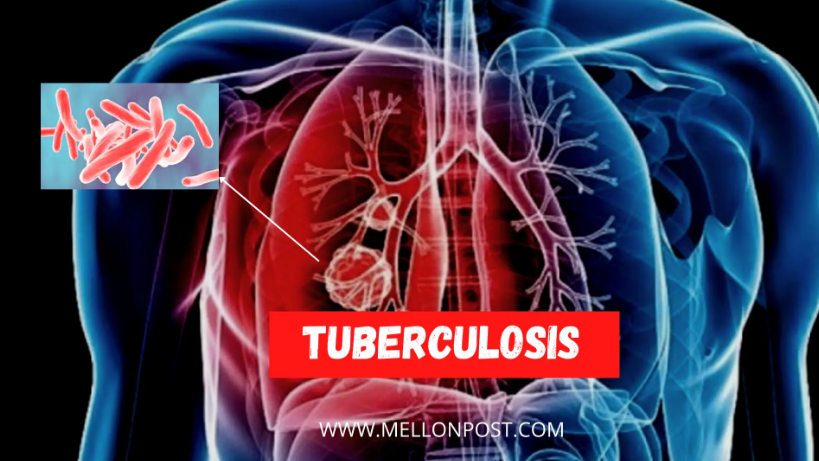 Tuberculosis: Causes, Symptoms, and Treatment | Medium
