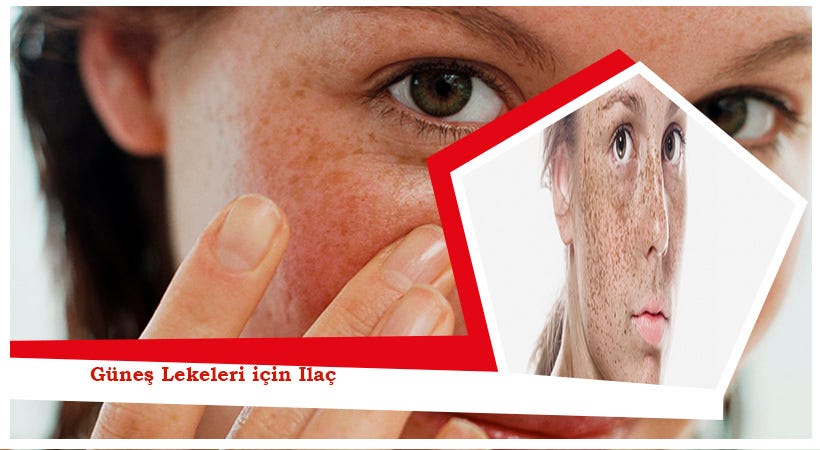 Güneş Lekeleri için İlaç. Güneş lekeleri için kullanılan ilaçlar… | by ...