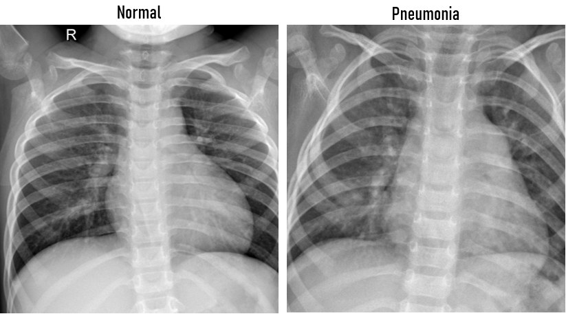 How I Built a Model That Detects Pneumonia | by Arslan Kamchybekov | Medium