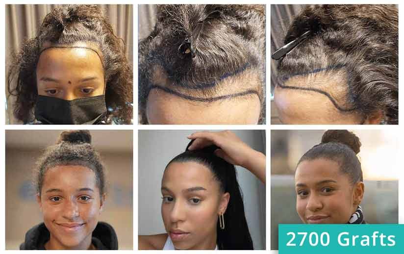 Follicular Unit Hair Transplantation: Strip Harvest Method | by Hamza ...