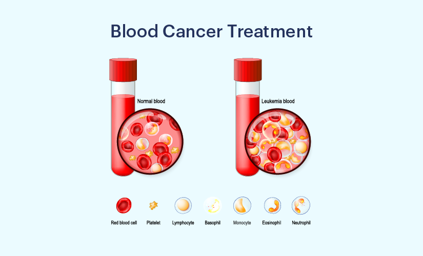 Chemotherapy Treatment For Leukemia