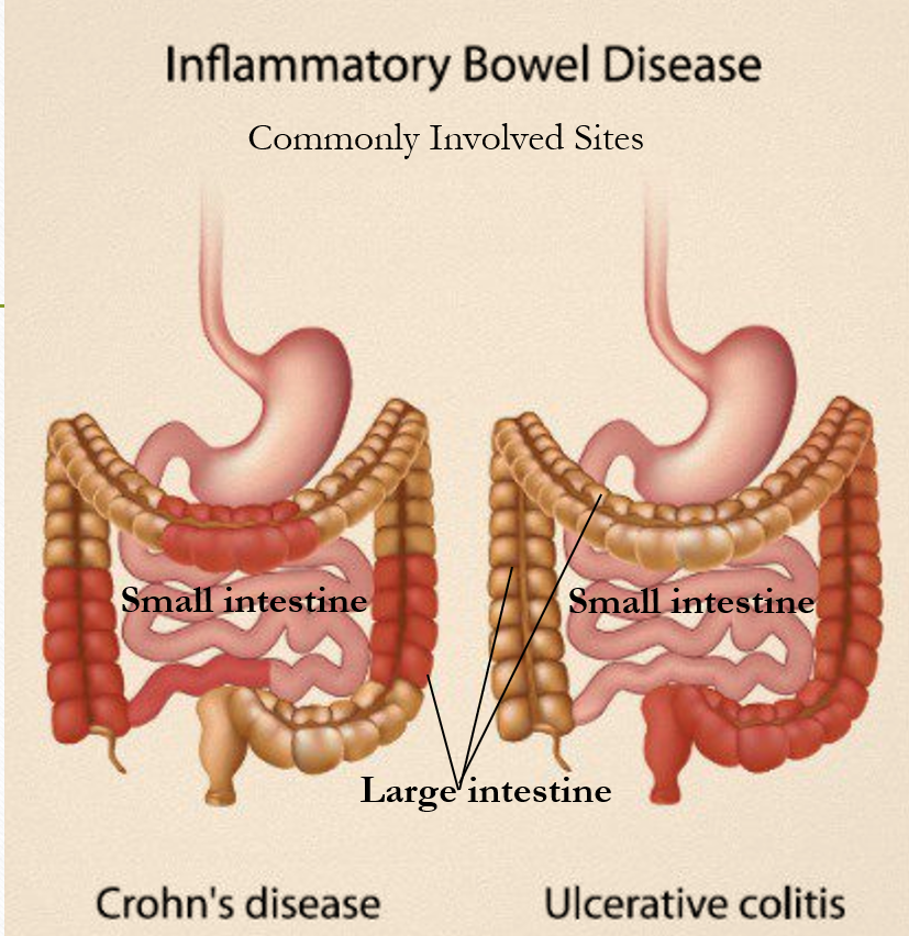 What Is Inflammatory Bowel Disease (IBD) and How Does It Affect You ...
