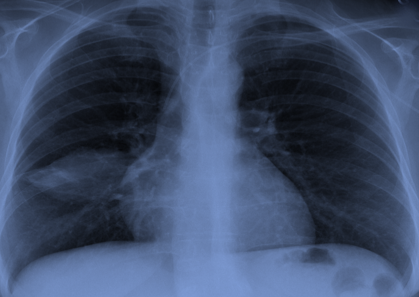 Chest X-ray Machine Learning data cleaning | Medium