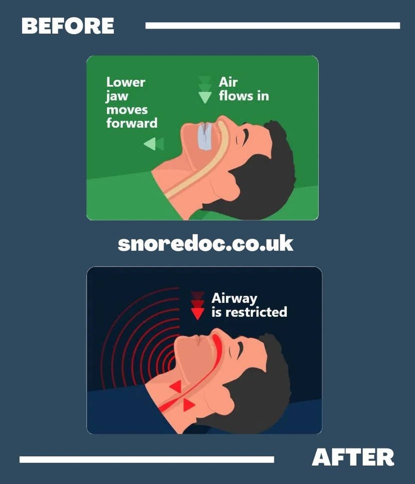 Anti Snoring Device | Checkout Best Anti Snoring Devices UK - Snore Doc - Medium