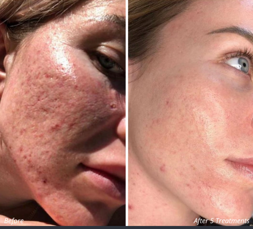Shedding Light on Laser Treatments — Debunking Common Myths | by ...