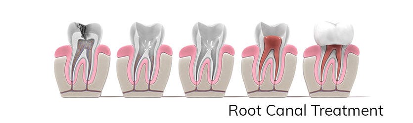 Root Canal Treatment (RCT) Doctors in Ghaziabad | by Dr. Devesh Jain ...