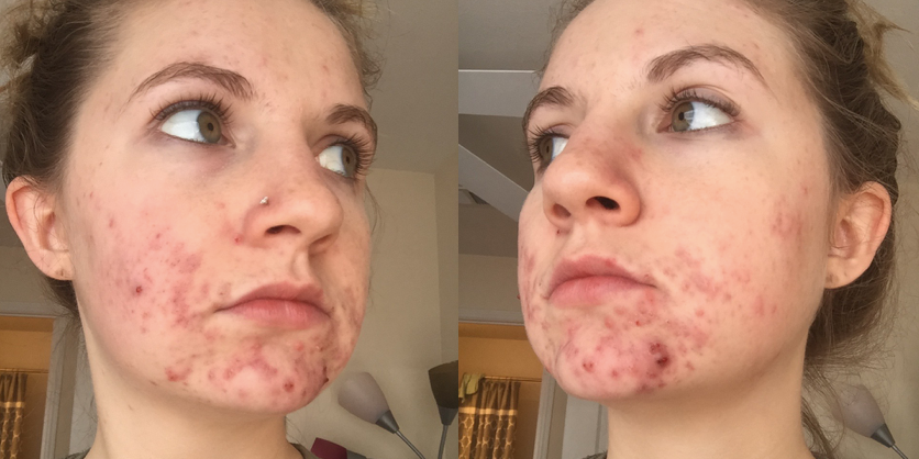 Accutane Before And After Chest