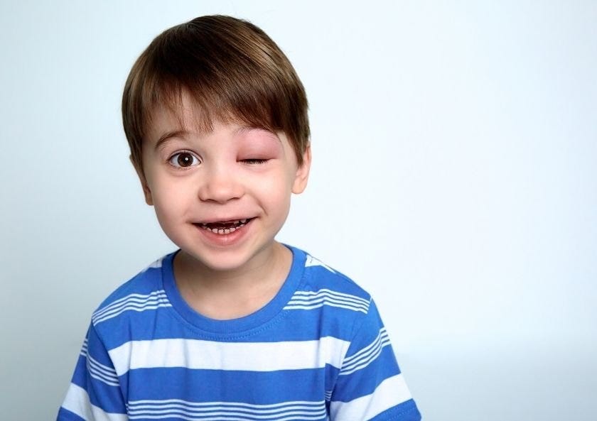 Swelling Stories: Navigating Hereditary Angioedema (HAE) | by Hayden ...