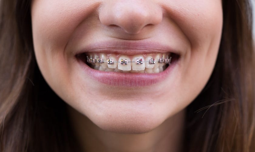 DIY Braces Care: How to Handle Emergencies at Home | by Woolaver ...