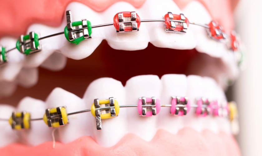 Braces for All Ages: Options for Adults and Children | by Hildebrand ...