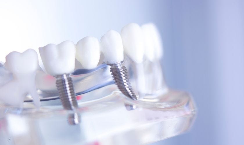 Recovery After Dental Implant Surgery in Woodbridge: A Guide | Medium