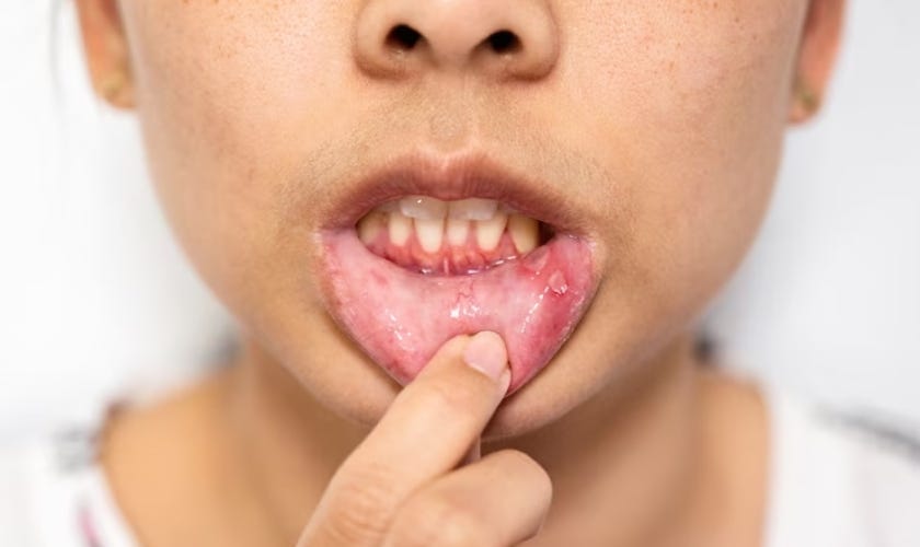 Signs of HPV in the Mouth. Discover signs of oral HPV at Belmont… | by Belmont Dentistry | Medium