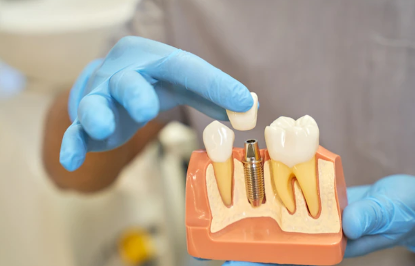 How To Heal Faster After Getiting A Dental Implant? | Medium