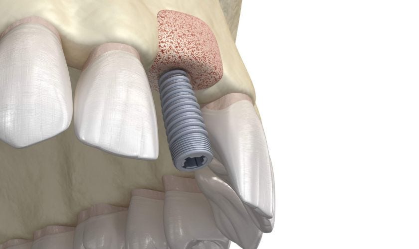 10 Things to Know Before Getting Bone Grafting for Dental Implants | by ...