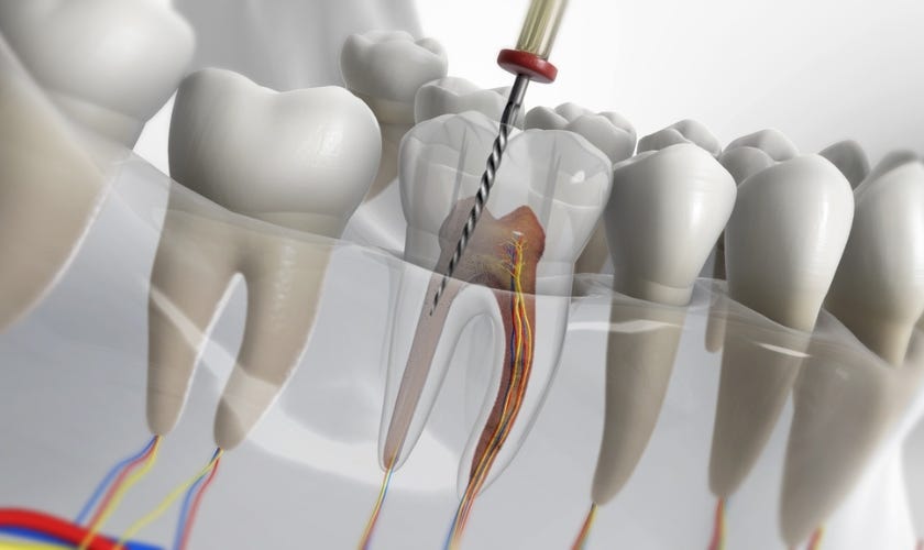 5 Common Misconceptions About Root Canals | by ShineFamilyDentistry Garnar | May, 2024 | Medium