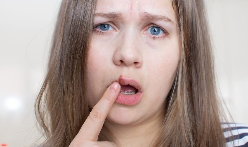 Cold Sores Understanding The Connection With Herpes And Hivaids By Dental Group Of Lubbock