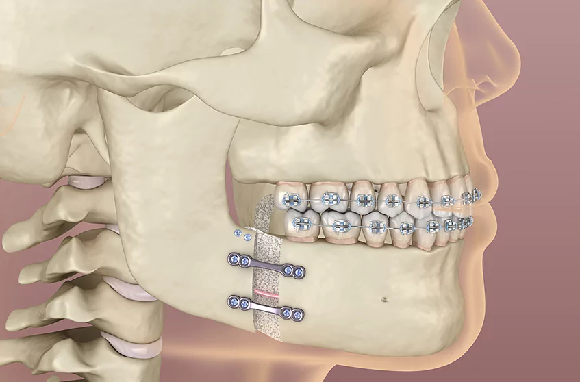Corrective Jaw (Orthognathic) Surgery: Types of Procedures and ...