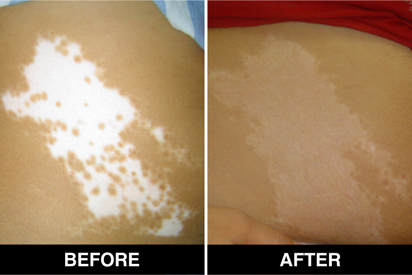 The Best Approach to Get Vitiligo Treatment Without Any Side Effect ...