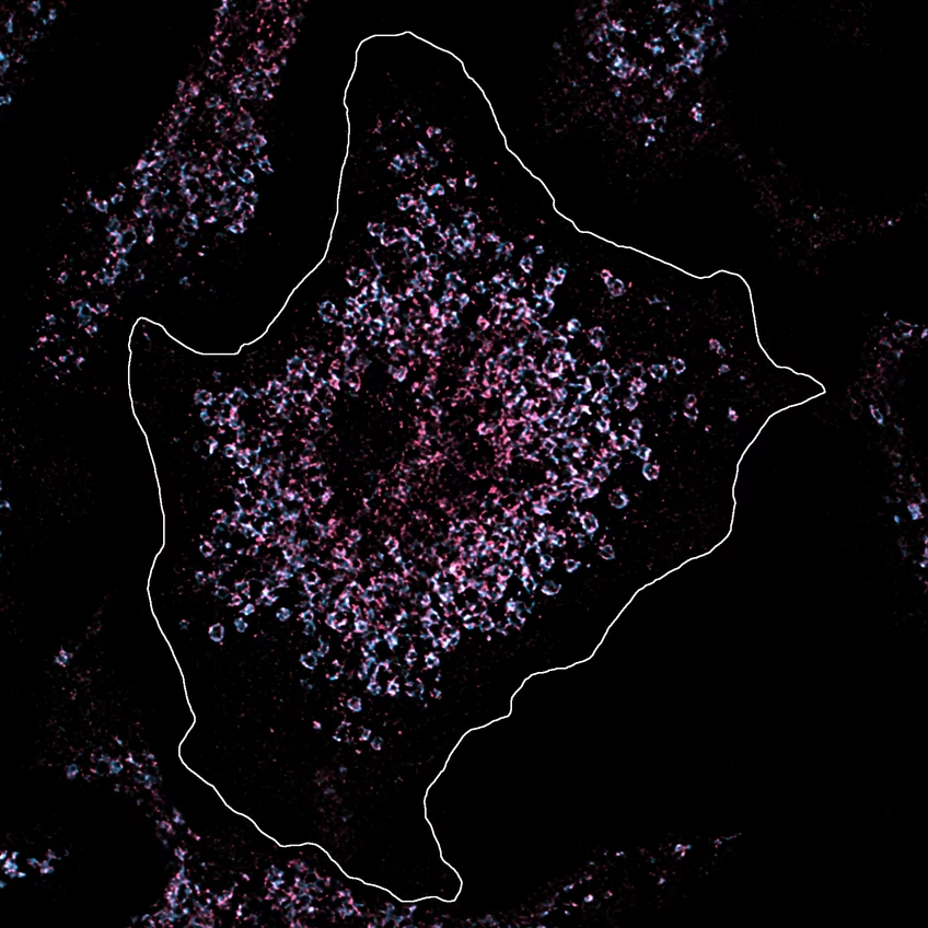 “Uncovering the Hidden Triggers: A Deep Dive into Lupus Root Causes ...