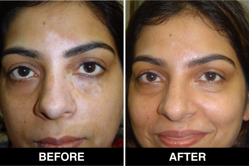 How to find Vitiligo Specialist & White Patches Treatment in Delhi | by ...