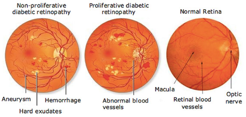 Neovascularization Analysis for Diagnosis of proliferative Diabetic ...