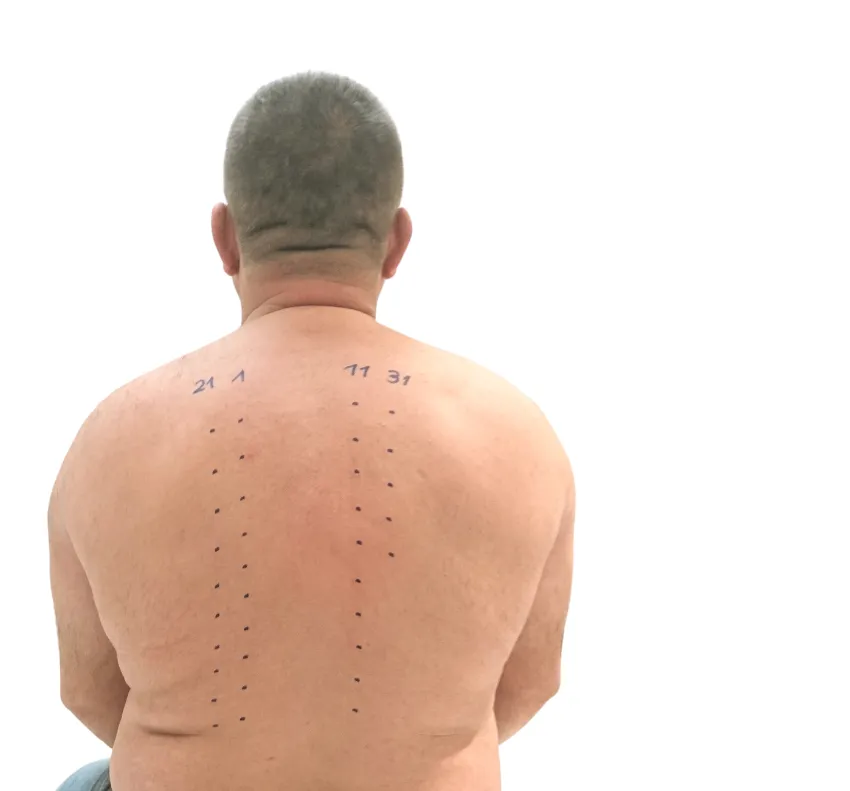 Understanding Allergy Skin Testing: A Comprehensive Overview | by ... Understanding Allergy Skin Testing: A Comprehensive Overview | by ...