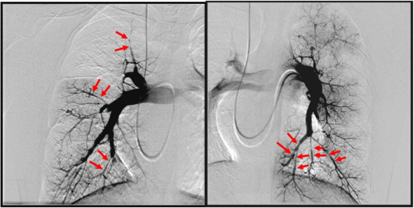 Pulmonary angiography. Angiography is a type of X-ray used to… | by Dem ...
