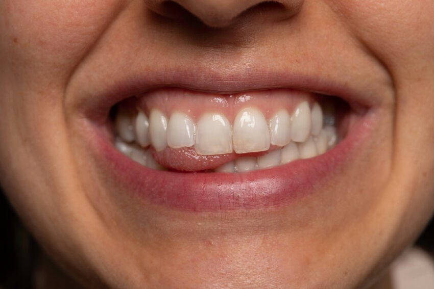10 Tips for Making a Shapelier Smile with Gum Line Contouring | by ...
