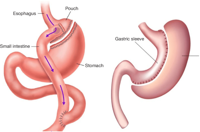 What is Roux-en-Y Gastric Bypass (RYGB) Procedure? | by Dr. Sukhvinder Singh Saggu - COMS Clinic ...