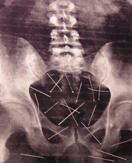 Albert Fish X Ray