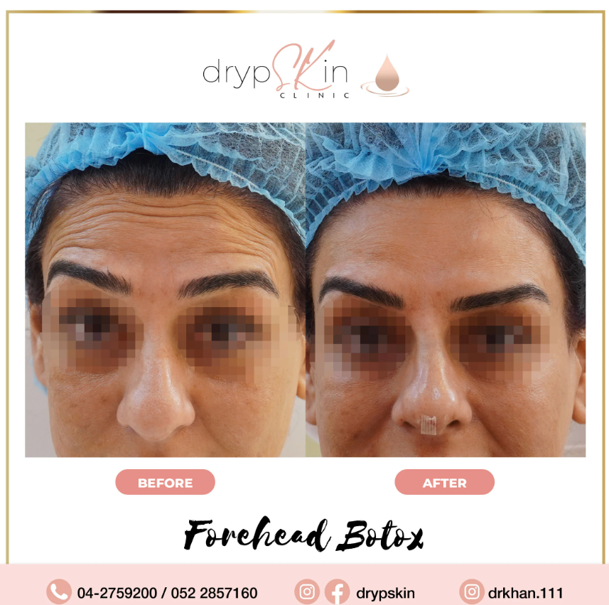 The Secret Behind Smooth, Youthful Skin: Botox Explained- Dubai | Drypskin? | by ...