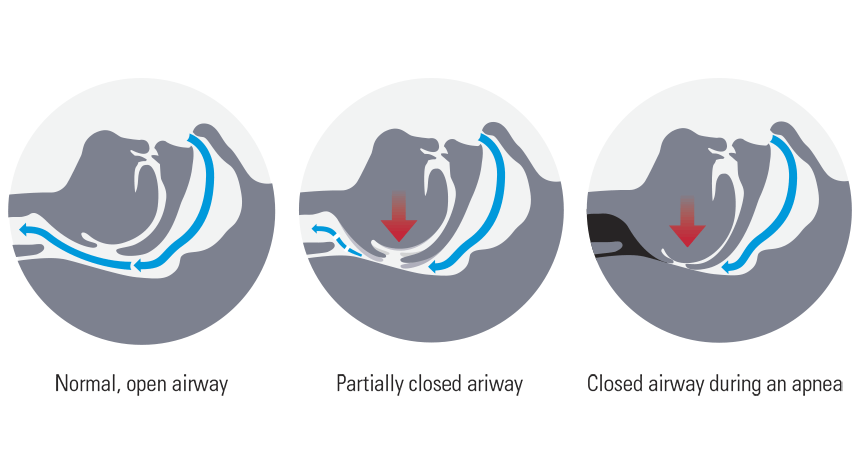 What is Sleep Apnea?. Sleep apnea is a breathing disorder… | by Seemab ...