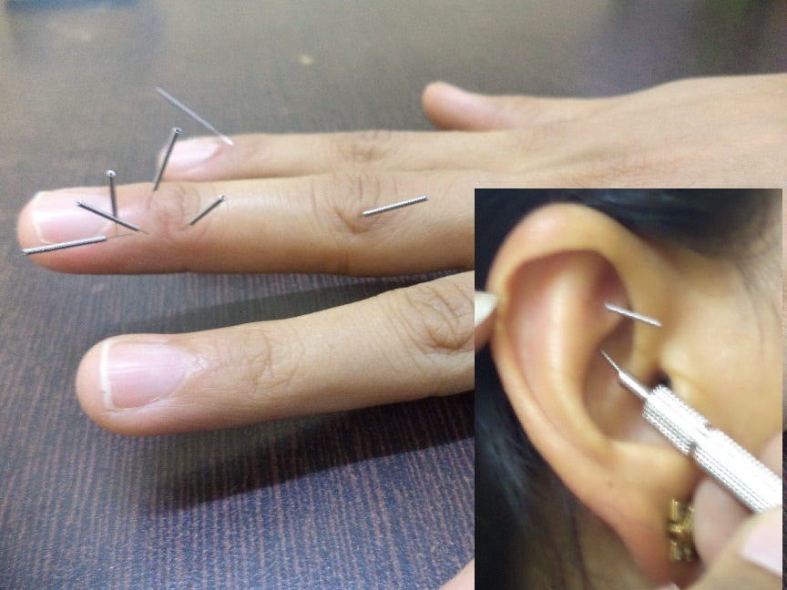 Attain The Best Magical Acupuncture Treatment In Delhi | by Acupuncture ...