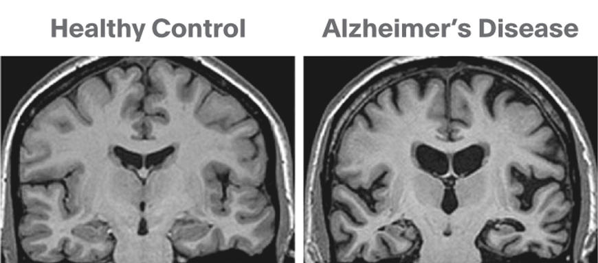 All About Alzheimer’s Disease. What Is Alzheimer’s Disease? | by Ellie ...