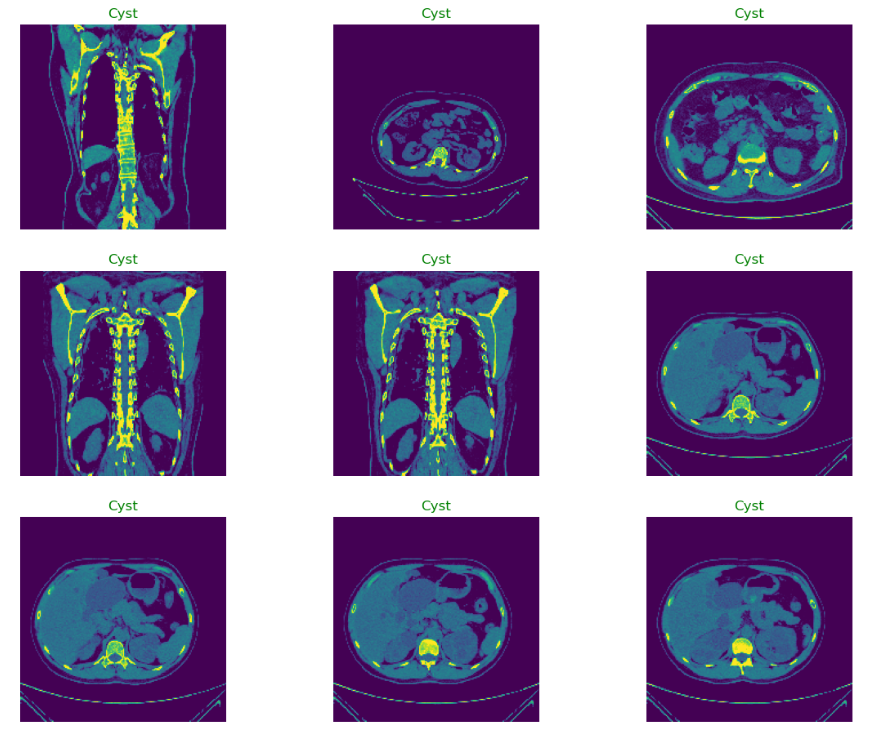 Cyst Kidney Detection using Convolutional Neural Network | by Vincent ...