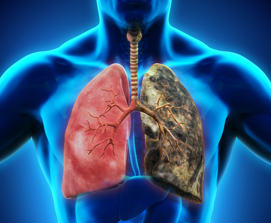 Why Smoking is Dangerous?. Smoking is one of the leading causes of ...