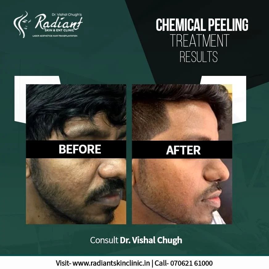 The Best Chemical Peeling Clinic in Jaipur:Radiant Skin, Hair & ENT ...