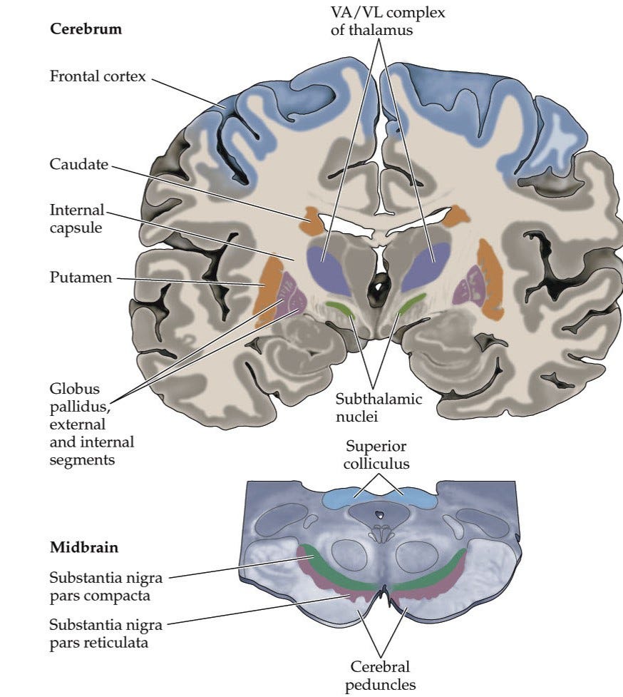 Neuropathology of Huntington’s Disease | by Jesse Sanchez | Words ...