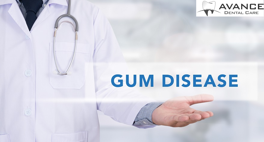 What Is the Link between Gum and Cancer? | by Dental Implants Cost | Medium