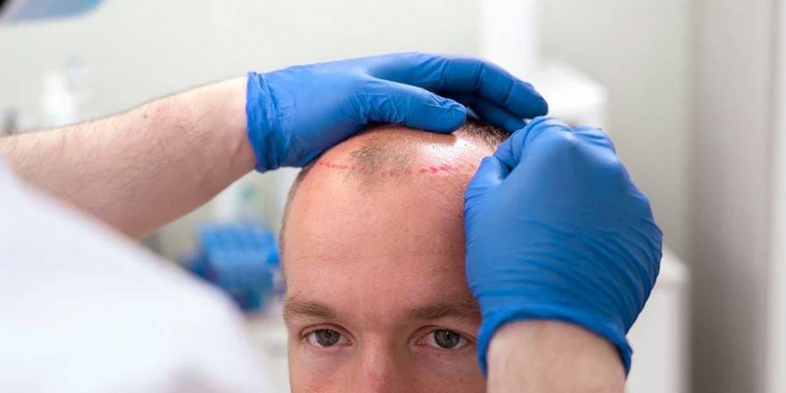 Choosing the Best Hair Transplant: A Guide to Hair Restoration Options ...