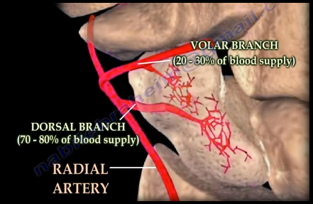 Scaphoid Fracture Avascular Necrosis