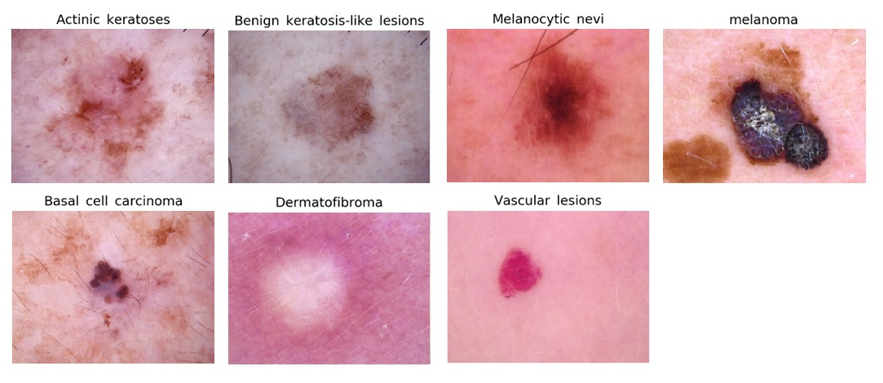 Skin Lesion Classification with Deep Learning: A Transfer Learning ...