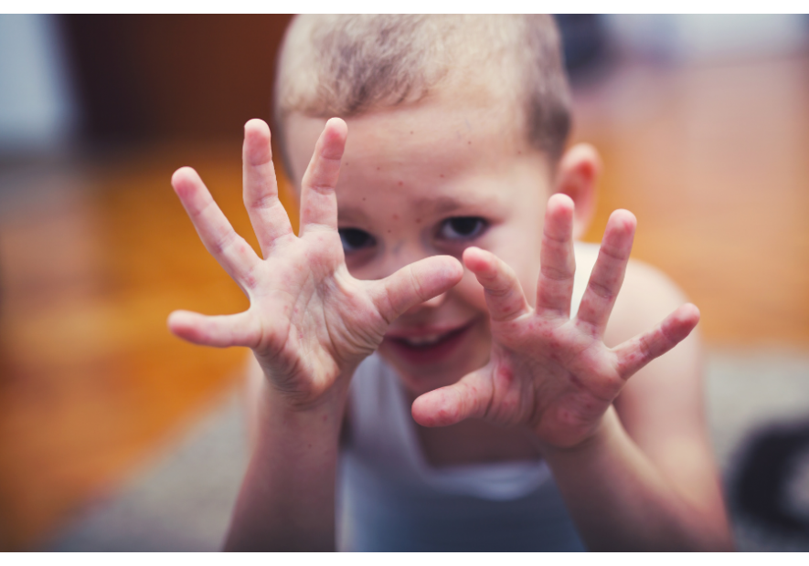 Hand Foot and Mouth Disease Prevention, The Most Effective Ways to ...