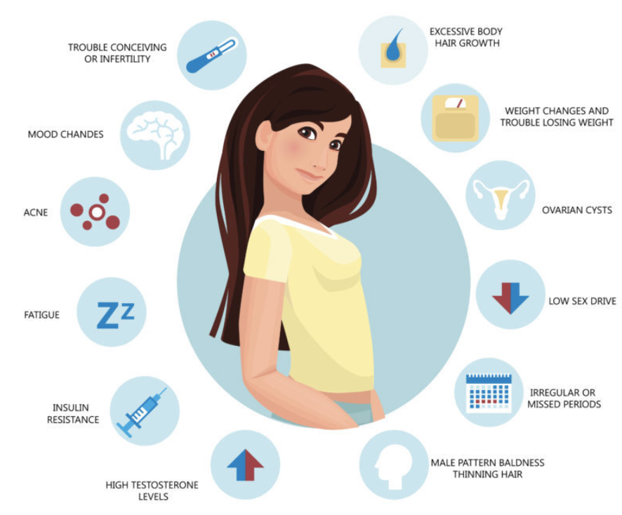 Male Pattern Baldness In Women Pcos
