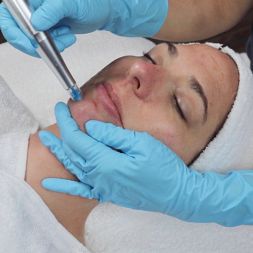 Nano Needling — Rejuvenate and Smooth Your Skin | by Katherine ...